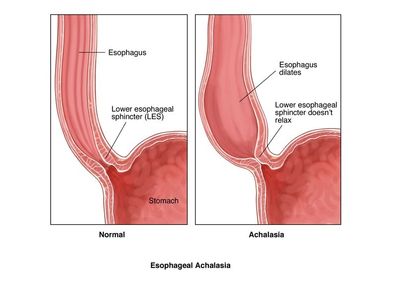 Esophageal Achalasia Overview Dr Anastasios Christodoulou Esophageal Achalasia Overview Dr Anastasios Christodoulou